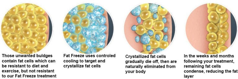 Freeze Your Fat | Spoiled Laser